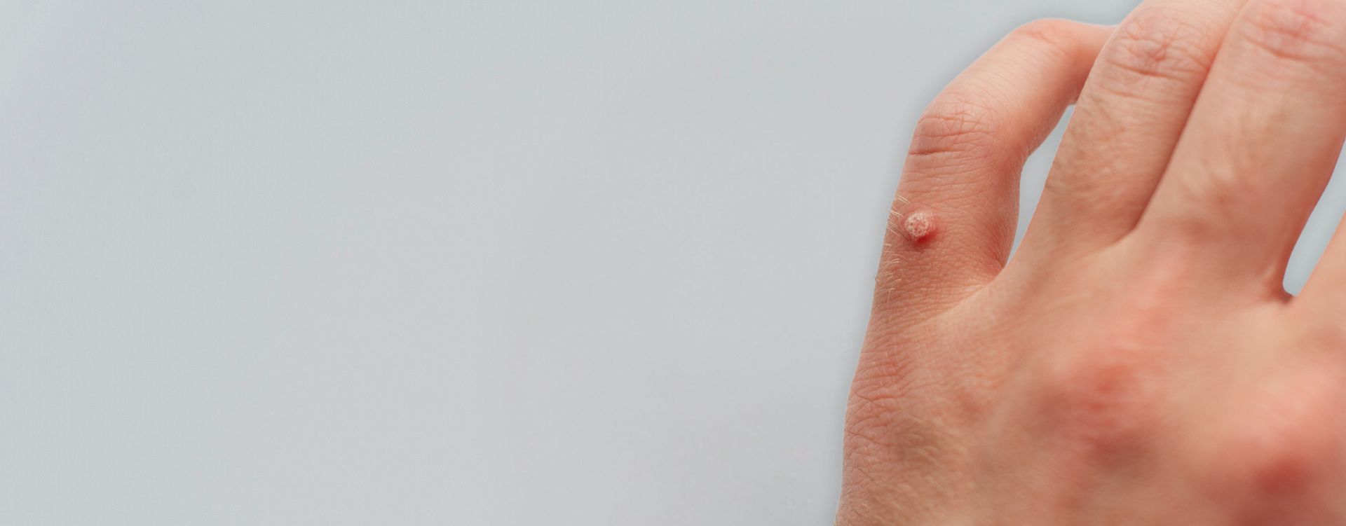 Warts Treatment | Rejuvenation Calgary North | Danny Guo MD